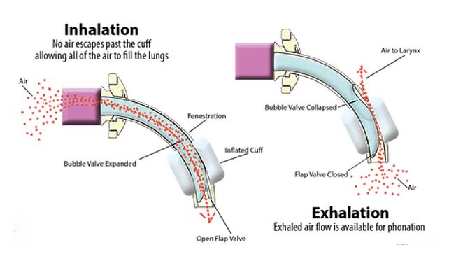 Tracheostomy: Definition, Types, Uses, Risks, and Cost