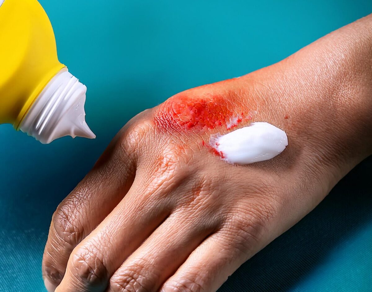 Top 5 Benefits of Using Triad Cream for Wound Healing