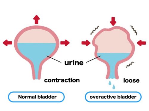 PureWick Male External Catheter: What Is It, How to Use it and FAQs